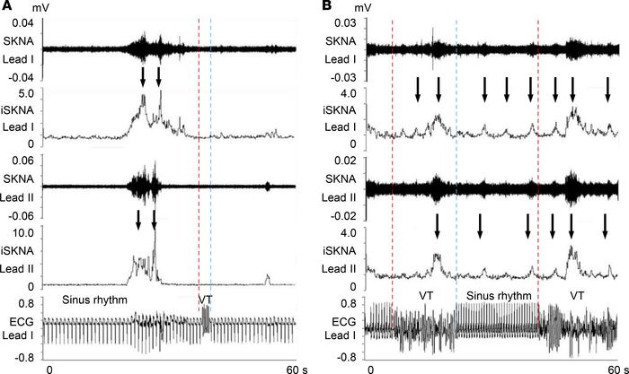 JCI Insight - Skin sympathetic nerve activity and the temporal ...