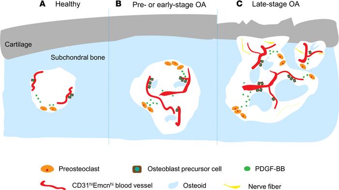 JCI Insight - Angiogenesis stimulated by elevated PDGF-BB in ...