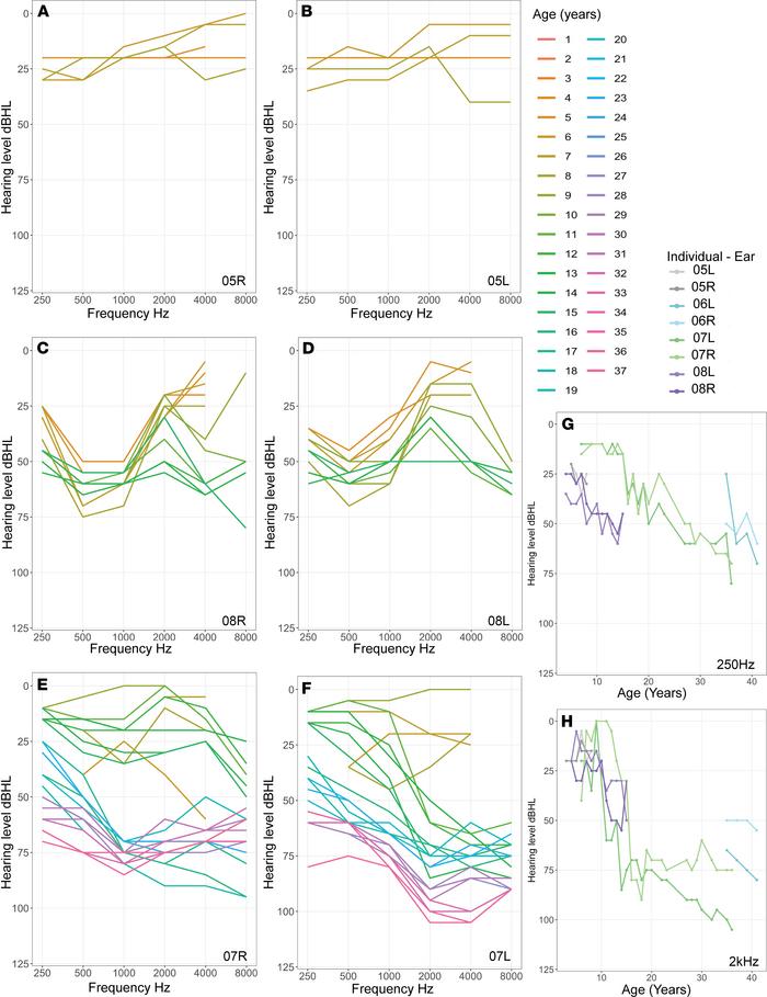 JCI Insight - The timing of auditory sensory deficits in Norrie disease ...