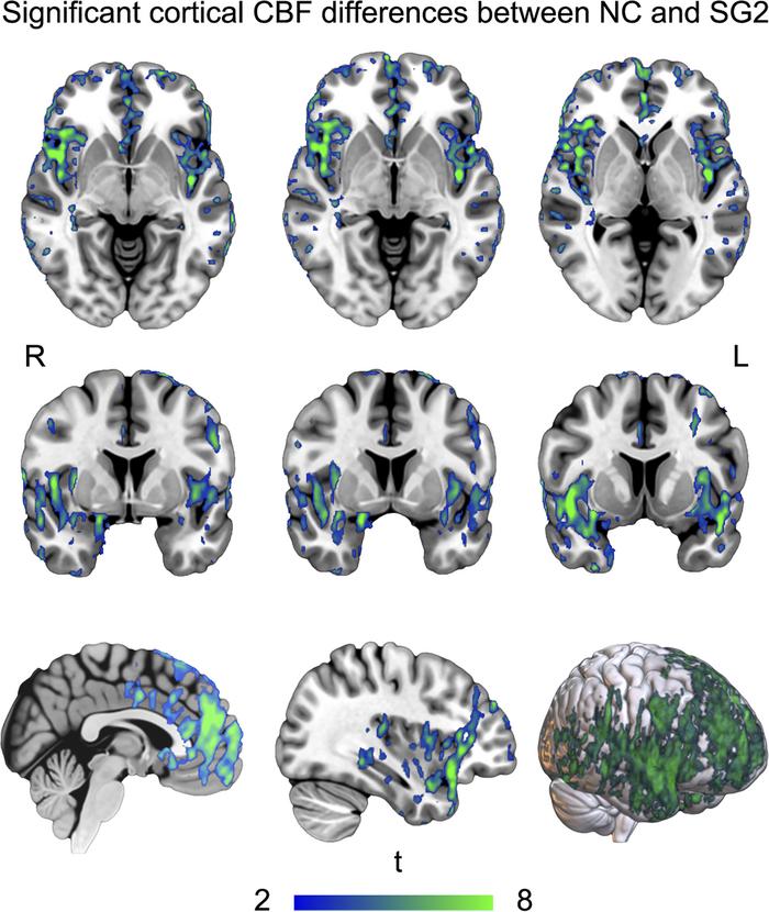 JCI Insight - Long-term follow-up of dynamic brain changes in patients ...