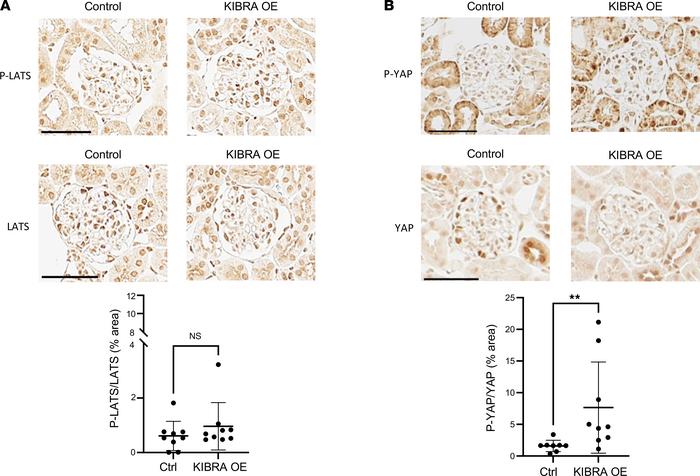 JCI Insight - KIBRA upregulation increases susceptibility to podocyte ...