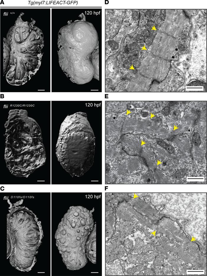JCI Insight - Biallelic variants in FLII cause pediatric cardiomyopathy ...