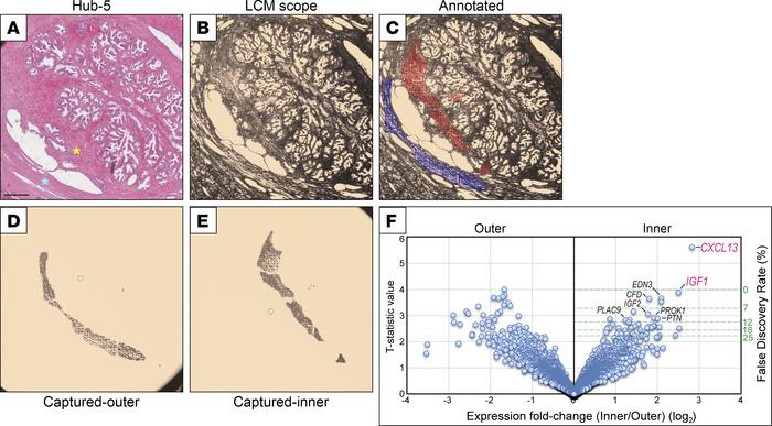 JCI Insight - Spatial transcriptomics identifies candidate stromal ...