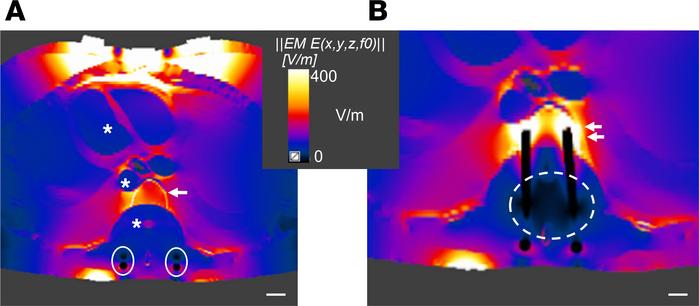 JCI Insight - Tumor treating fields suppress tumor cell growth and ...