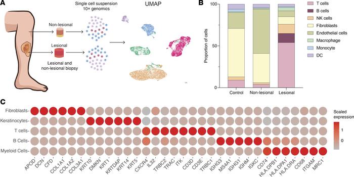 JCI Insight - SPP1hi macrophages, NKG7 T cells, CCL5hi fibroblasts, and ...