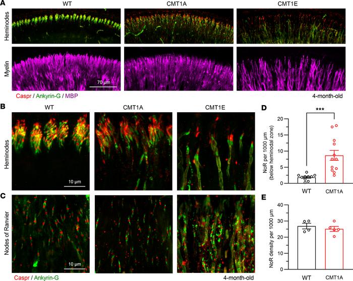 JCI Insight - Hidden hearing loss in a Charcot-Marie-Tooth type 1A ...