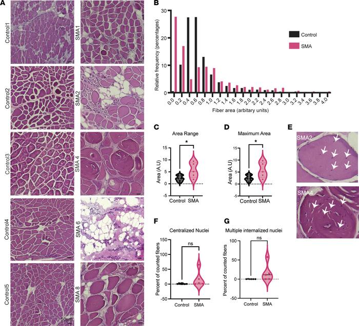 JCI Insight - Characterization of SMA type II skeletal muscle from ...