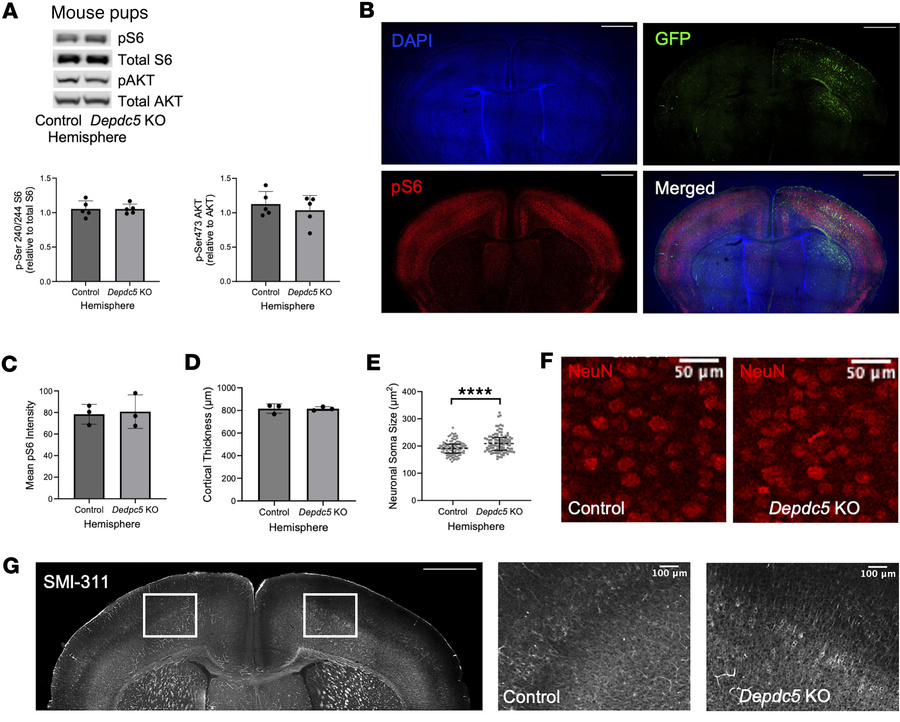 JCI Insight - Focal DEPDC5 loss without disruption to cerebral cortical ...