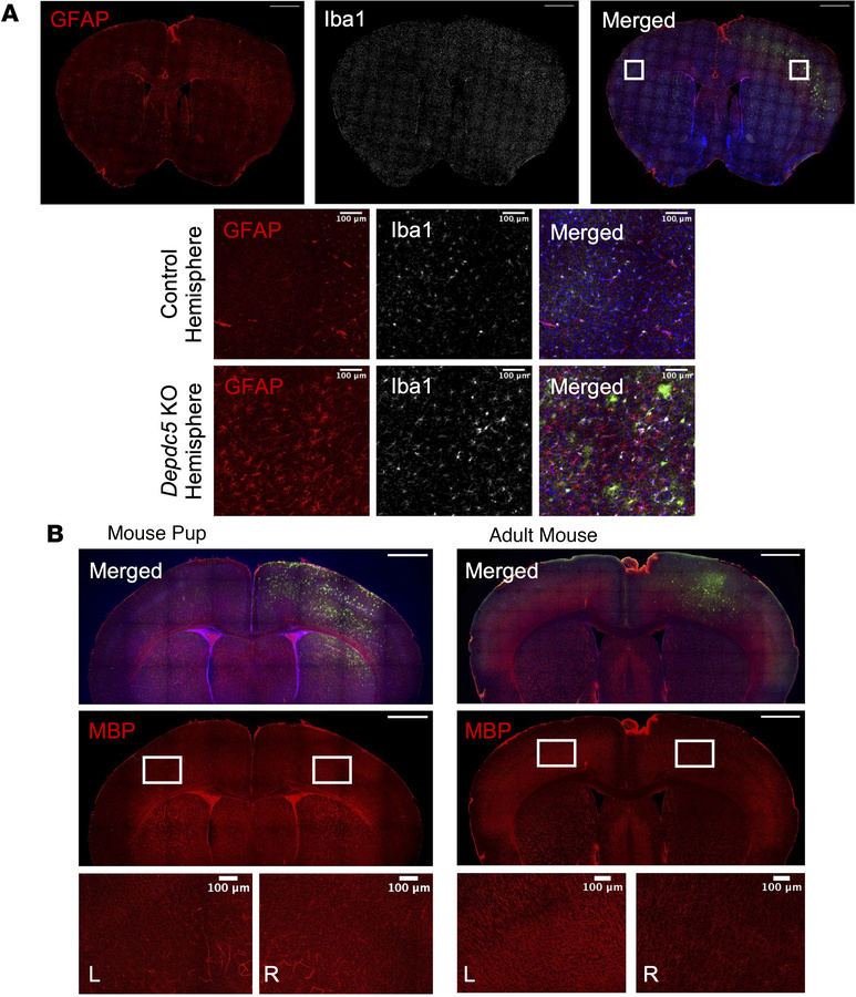 JCI Insight - Focal DEPDC5 loss without disruption to cerebral cortical ...