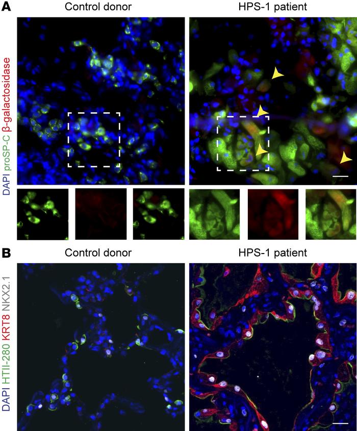 JCI Insight - Dysregulated alveolar epithelial cell progenitor function ...