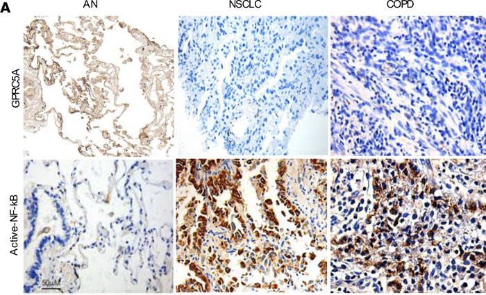 JCI Insight - NF-κB represses retinoic acid receptor–mediated GPRC5A ...