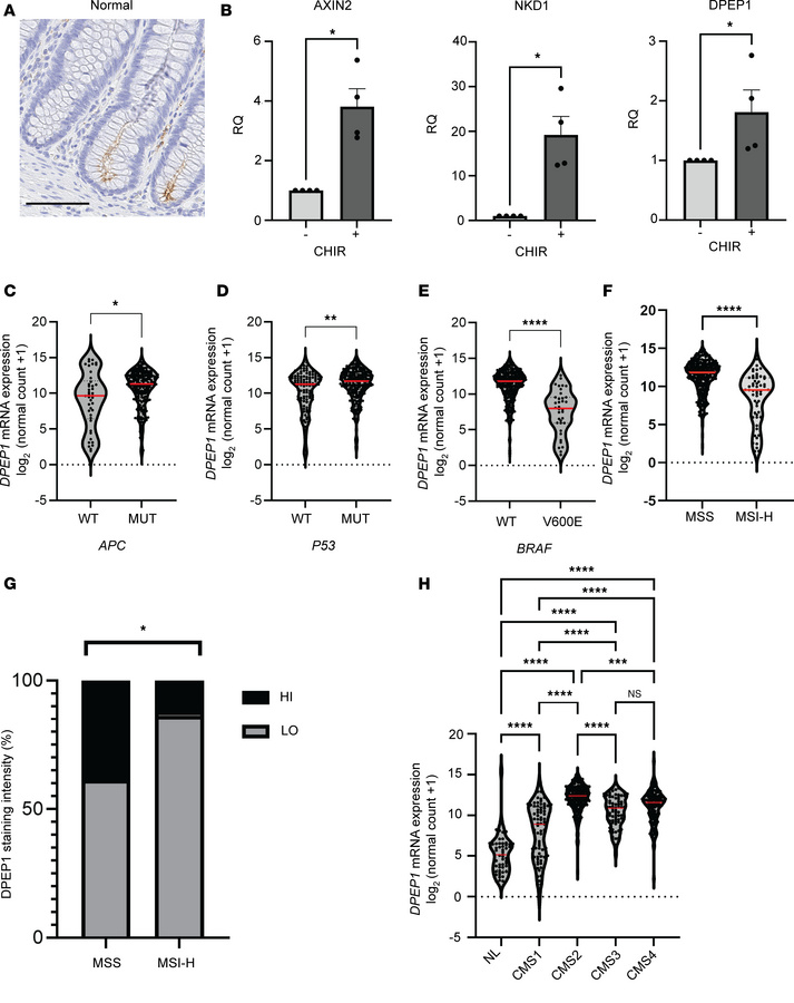 JCI Insight - Dipeptidase-1–knockout mice develop invasive tumors with ...