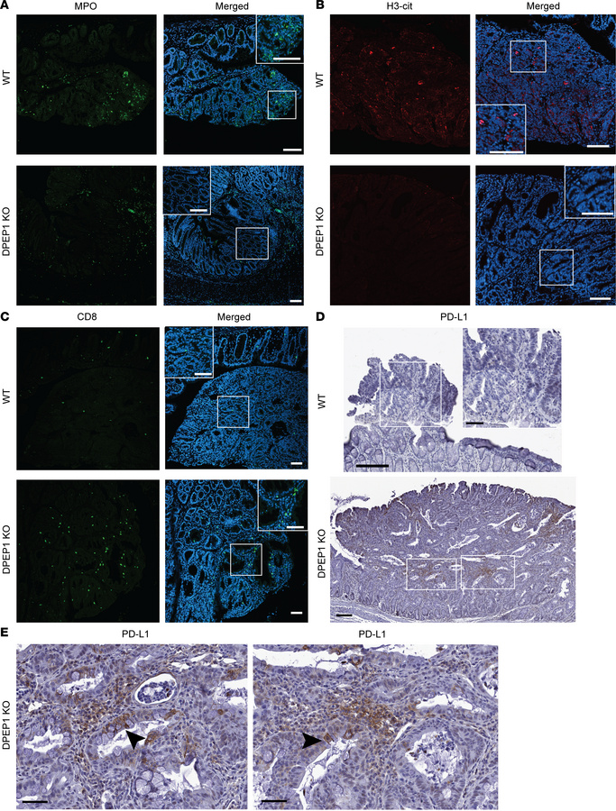 JCI Insight - Dipeptidase-1–knockout mice develop invasive tumors with ...