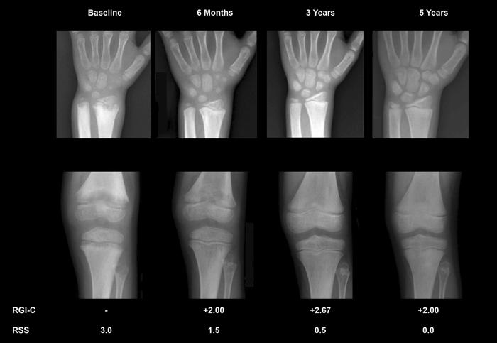JCI Insight - Asfotase alfa therapy for children with hypophosphatasia