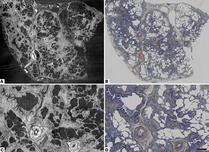 JCI Insight - Three-dimensional characterization of fibroblast foci in ...