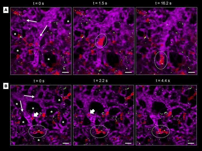 JCI Insight - Lung vaso-occlusion in sickle cell disease mediated by ...