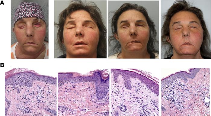 JCI Insight - Longitudinal immunological characterization of the first ...