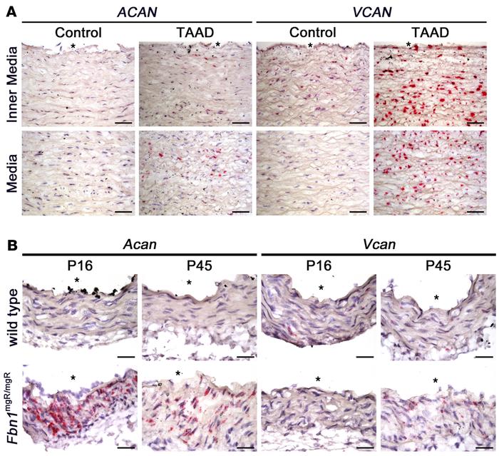JCI Insight - Massive aggrecan and versican accumulation in thoracic ...